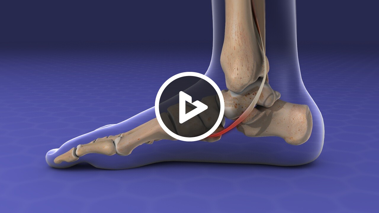 Adult Acquired Flatfoot - Foot and Ankle - Willis Knighton Orthopedics ...