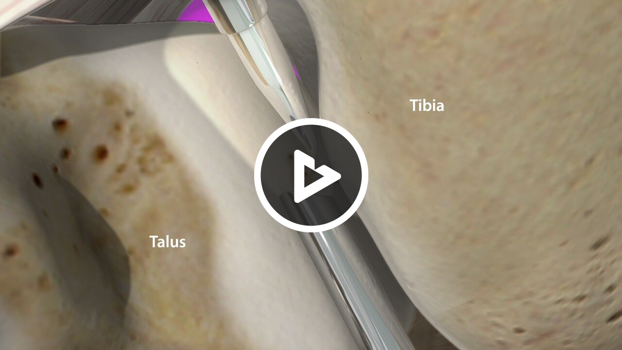 Arthroscopic Articular Cartilage Repair (Ankle) - Foot and Ankle ...