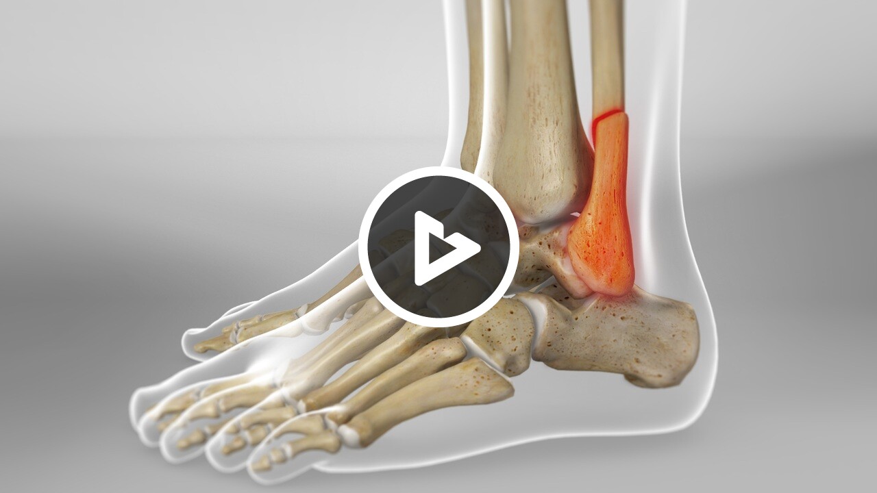 Ankle Fracture Surgery - Foot and Ankle - Willis Knighton Orthopedics ...