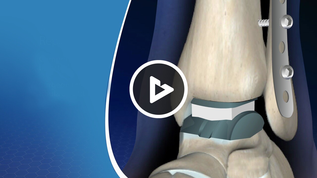 Ankle Replacement - Joint Replacement - Willis Knighton Orthopedics ...
