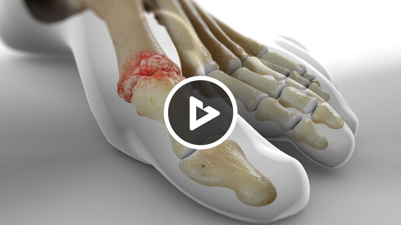 Cheilectomy - Foot and Ankle - Willis Knighton Orthopedics Bossier ...