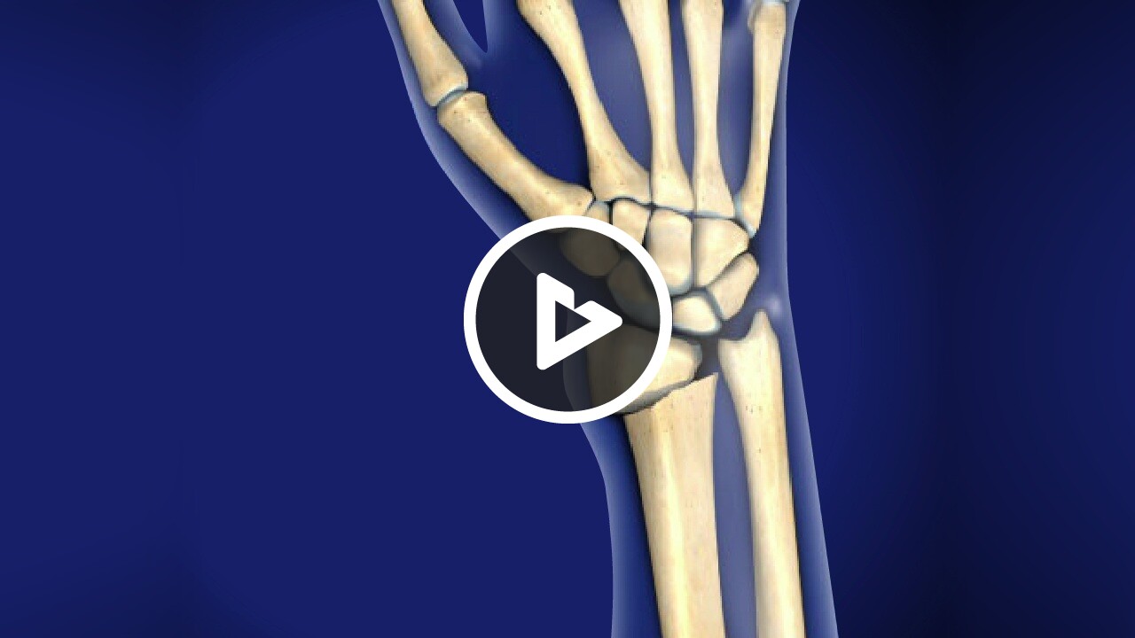 Distal Radius Fracture (Broken Wrist) - Wrist - Willis Knighton ...