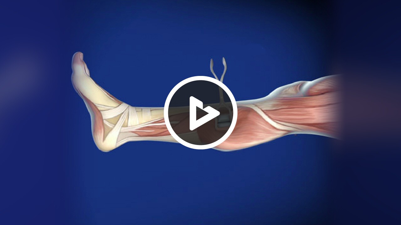 Gastrocnemius Recession (Intramuscular Approach) - Foot and Ankle ...