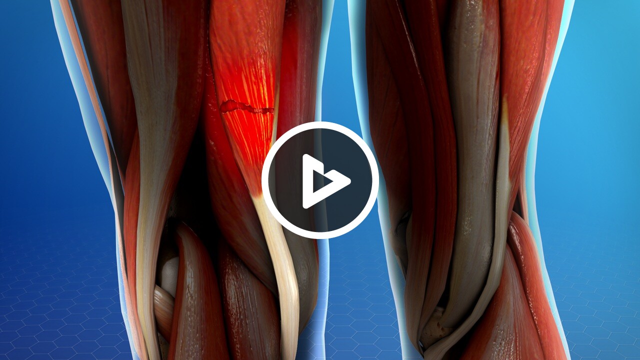 Hamstring Muscles Diagram Anatomy Of The Hamstring Muscles. 1