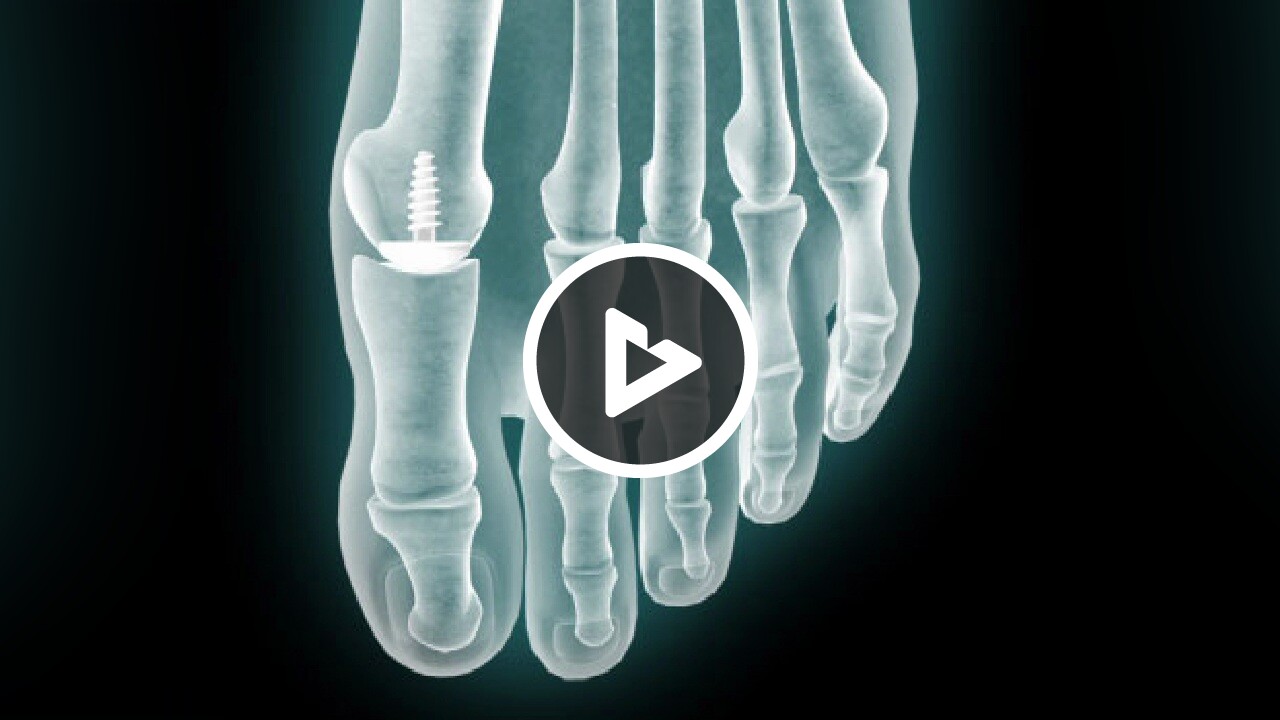 Arthrosurface HemiCAP Resurfacing for the Great Toe - Foot and Ankle ...