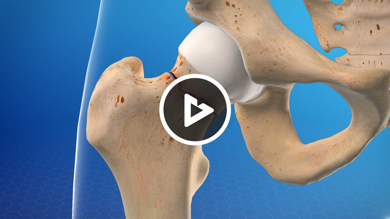 Hip Fracture - Lower Extremity - Willis Knighton Orthopedics Bossier ...