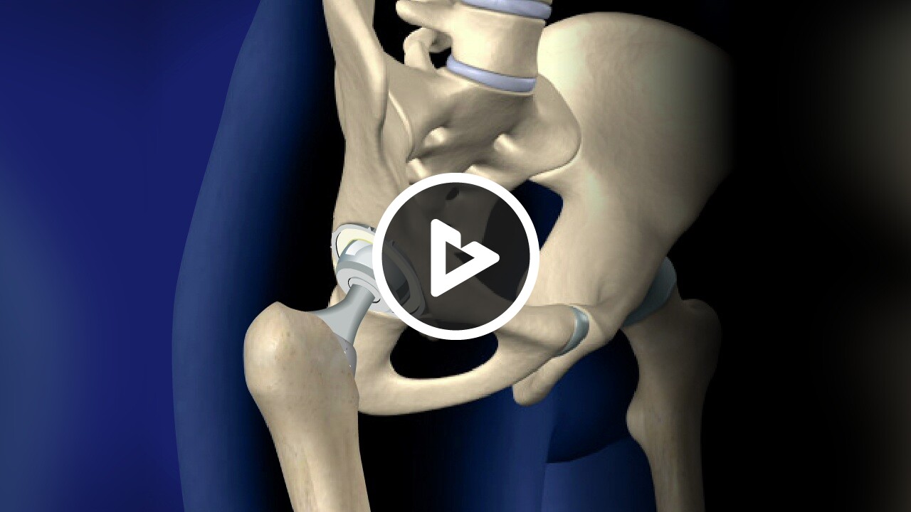 Total Hip Replacement, Anterior Approach - Joint Replacement - Willis ...