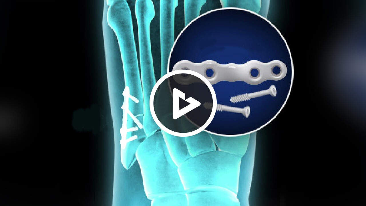 Jones Fracture Fixation (Intramedullary Screw) - Foot and Ankle ...