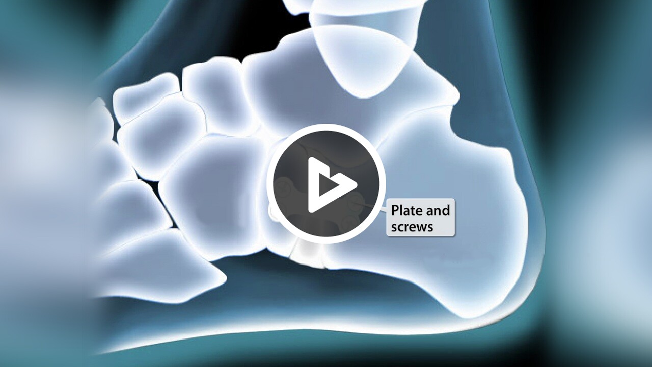 Lateral Column Lengthening (Evans Osteotomy) for Adult Acquired ...