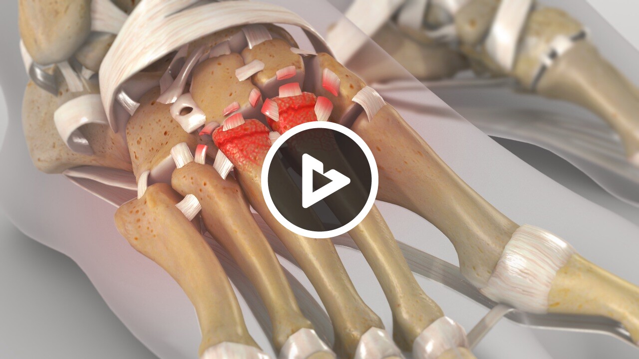Lisfranc Injury - Foot and Ankle - Willis Knighton Orthopedics Bossier ...