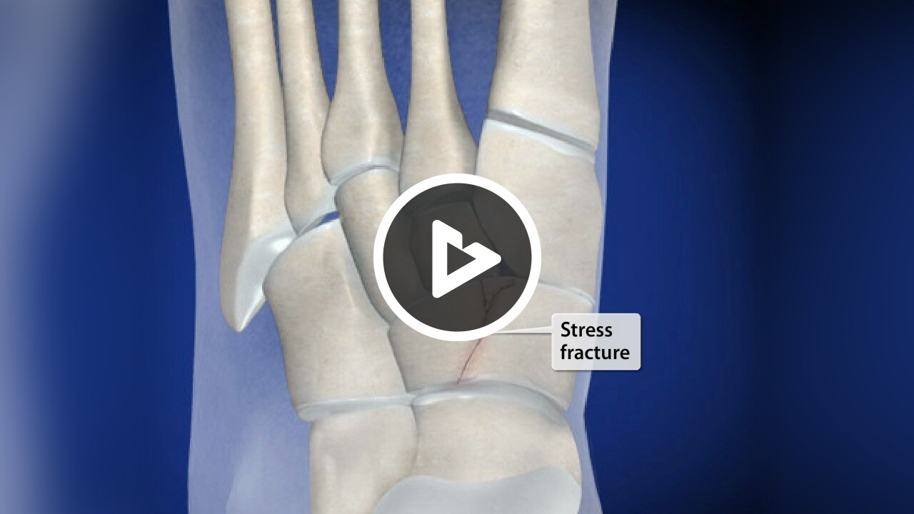 Navicular Stress Fracture - Foot and Ankle - Willis Knighton ...