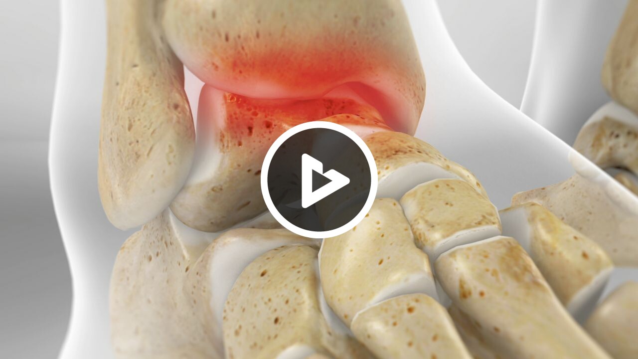 Osteochondral Lesion of the Talus - Foot and Ankle - Willis Knighton ...