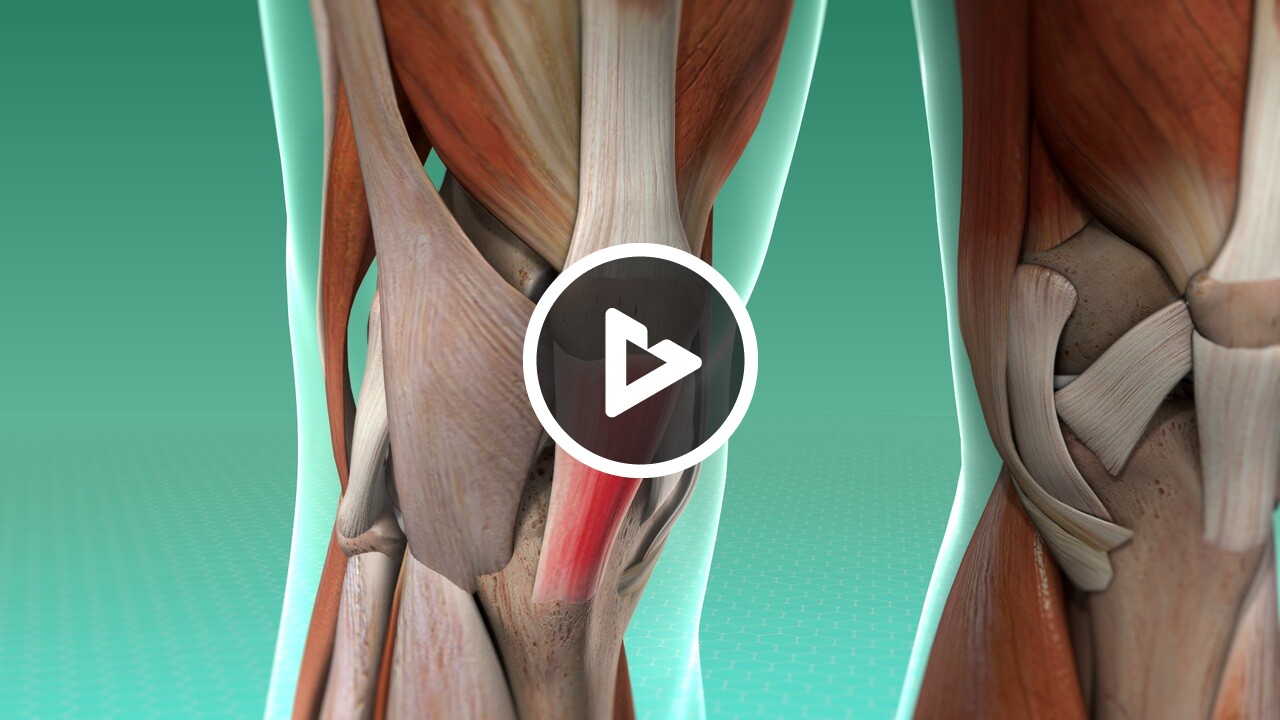 Patellar Tendinitis - Lower Extremity - Willis Knighton Orthopedics ...