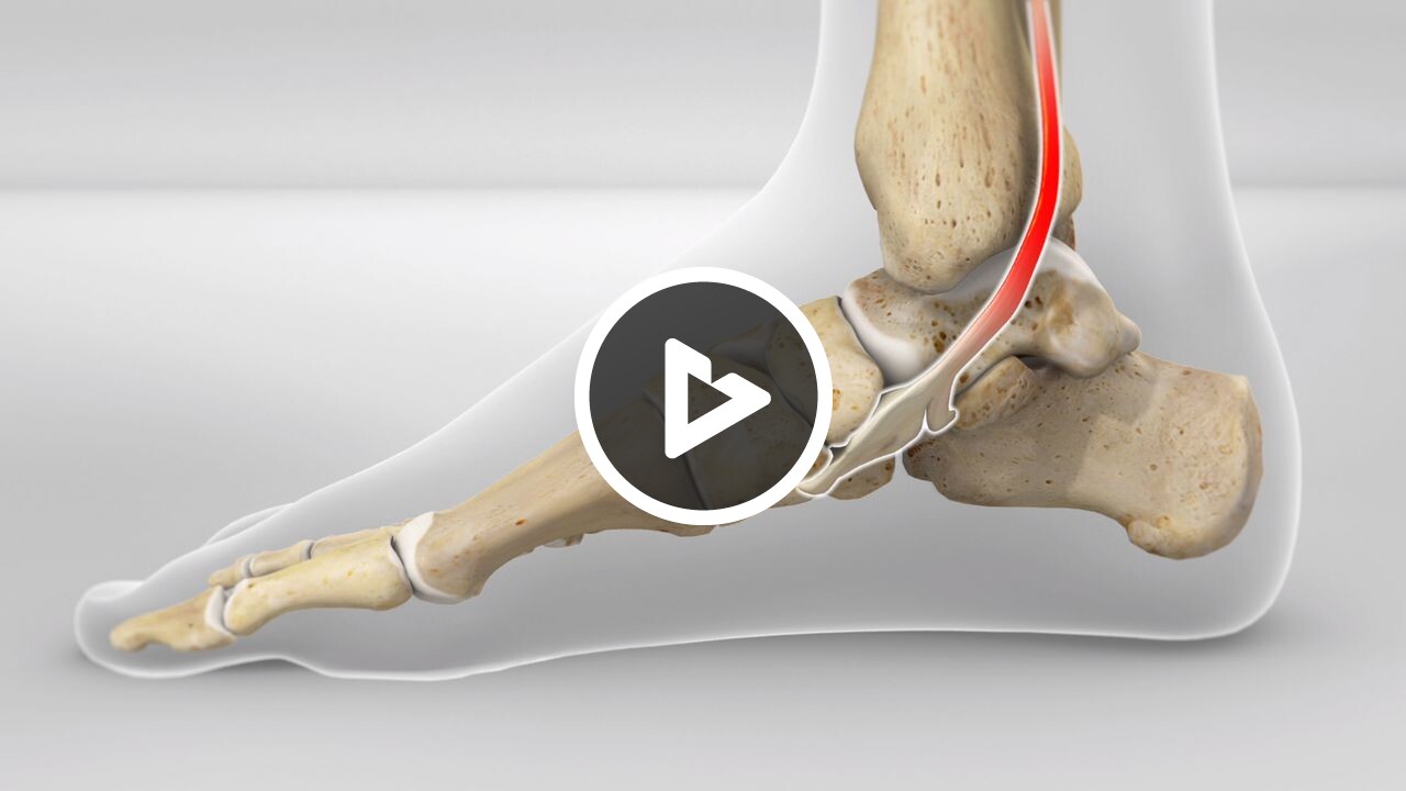 Posterior Tibial Tendon Dysfunction (PTTD) - Foot and Ankle - Willis ...