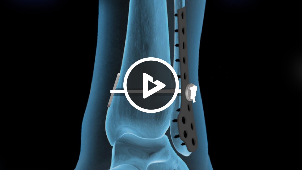 TightRope Fixation for Ankle Syndesmosis - Foot and Ankle - Willis ...