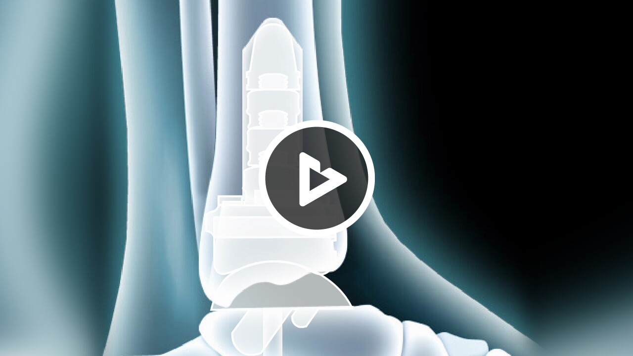 Total Ankle Joint Replacement (Wright INBONE II) - Joint Replacement ...