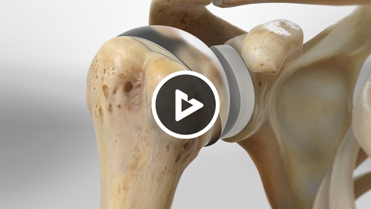 Total Shoulder Replacement - Joint Replacement - Willis Knighton ...